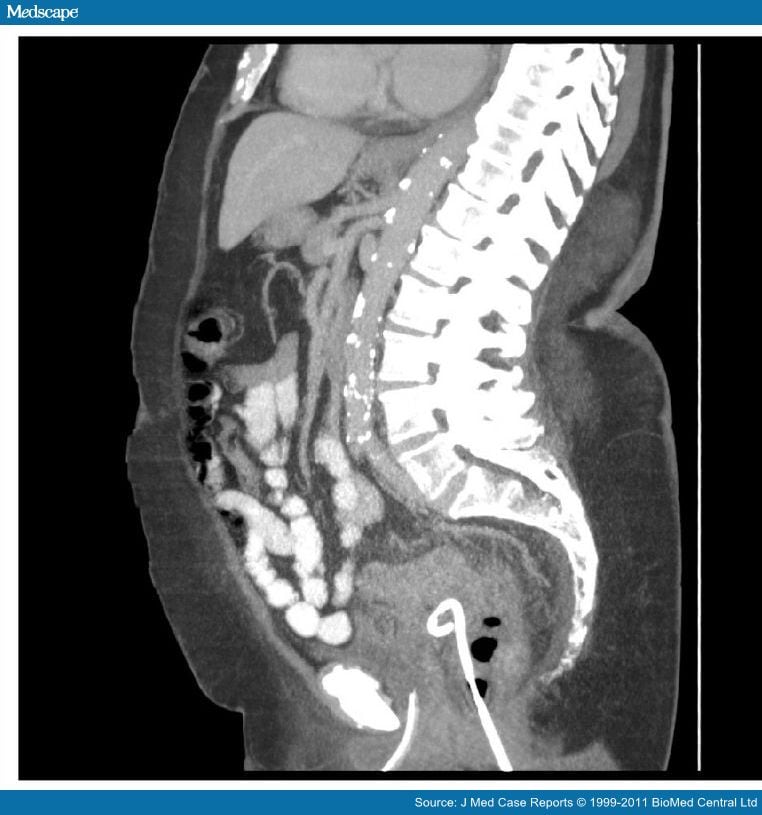 Transrectal Drainage Of A Diverticular Abscess