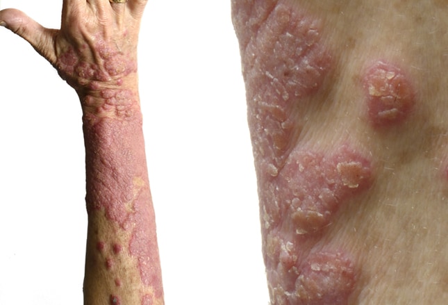 Psoriasis Manifestations Management Options And Mimics