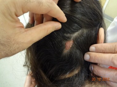 Epidermal Nevus Scalp Pathology Outlines Nevus Sebaceus Of Jadassohn