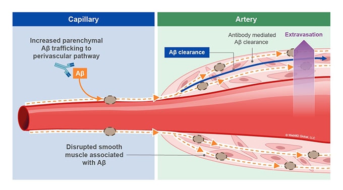 Putting ARIA Risk Into Perspective With Anti-Amyloid Monoclonal ...