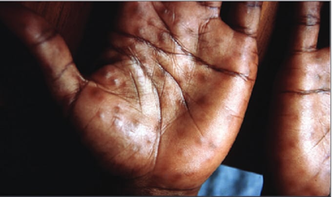 Syphilis and Congenital Syphilis on the Rise – How to Protect Your Patients