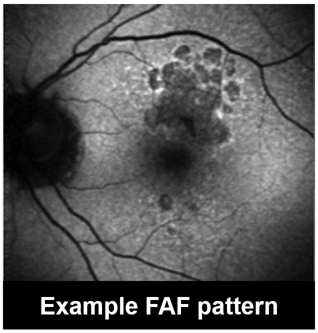 AMD and GA Cases: If and How to Treat