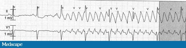 Atrial Flutter or Ventricular Tachycardia?