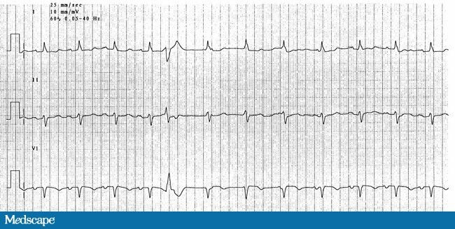 What Is Happening in the Middle of the Strips Following the PVC?