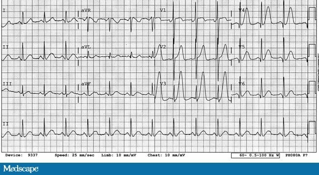 Series of Tall T Waves (I) - Page 2