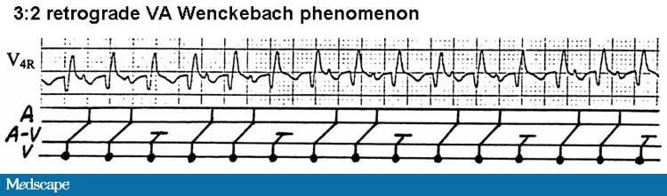 Variations on the Theme of the Wenckebach Phenomenon (III) - Page 2