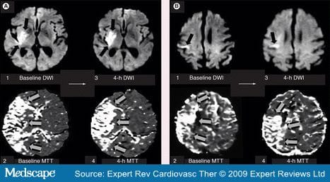 Neuroimaging of Ischemic Stroke With CT and MRI - Page 7
