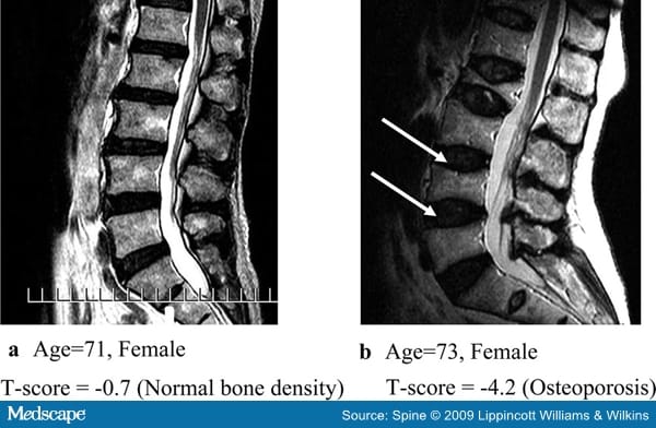 Effect of Osteoporosis on Morphology and Mobility of the Lumbar Spine