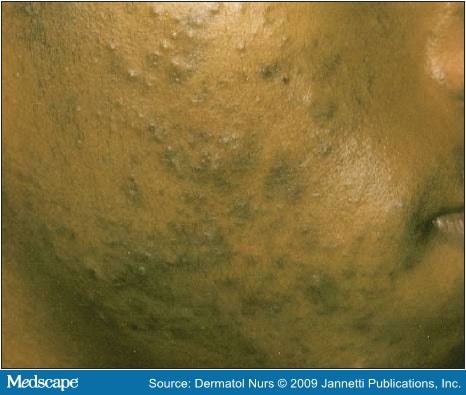 Concomitant Therapy for Acne in Patients With Skin of Color - Page 2