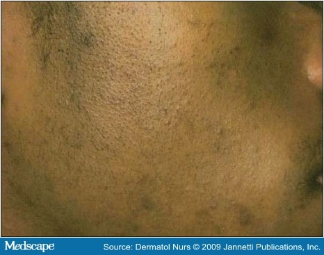 Concomitant Therapy for Acne in Patients With Skin of Color - Page 2