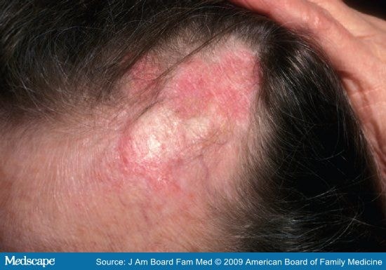 Early Diagnosis and Treatment of Discoid Lupus Erythematosus