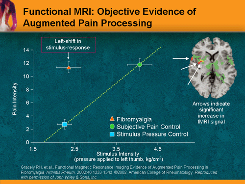 Fibromyalgia Pain Mechanisms: Functional Neuroimaging and Other Factors ...