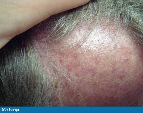 Acne in a Patient With Pancreatic Cancer