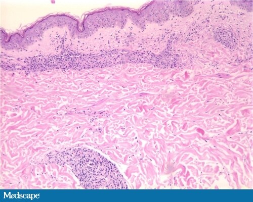 A 30-Year-Old Man With a 2-Year History of Rash