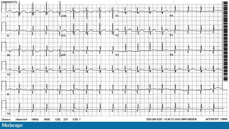 Abnormally Tall R Waves in V1