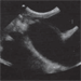 Management of Duplex System Ureteroceles in Neonates and Infants