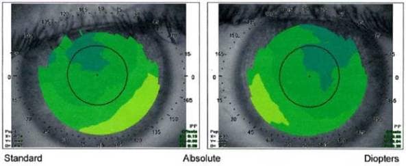 The VIEW II: Halting Progression of Dry Eye Disease