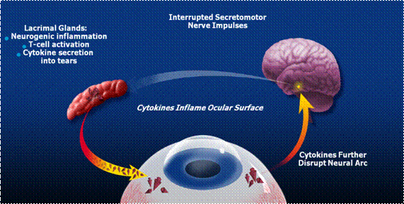 The VIEW II: Halting Progression of Dry Eye Disease