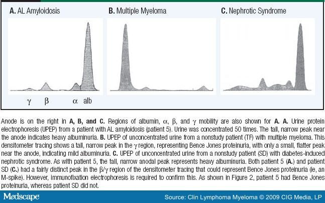 Urinary Findings in Renal Light Chain-Derived Amyloidosis and Light ...