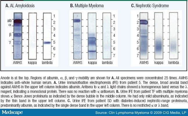 Urinary Findings in Renal Light Chain-Derived Amyloidosis and Light ...