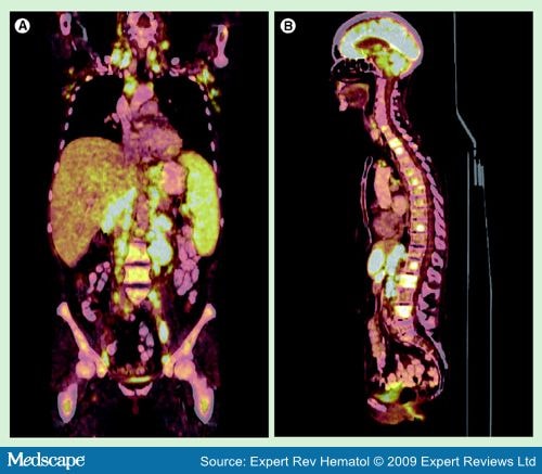 PET Imaging in Lymphoma - Page 3