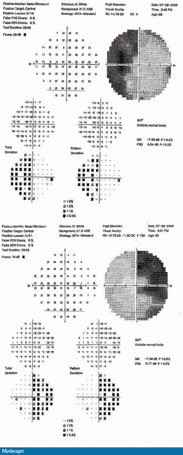 A 69-Year-Old Man With Decreased Vision and Abnormal Visual Field - Page 2