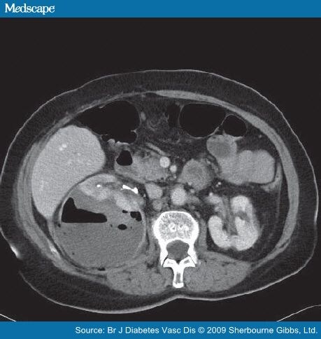 Diversity and Complexity of Urinary Tract Infection in Diabetes ...