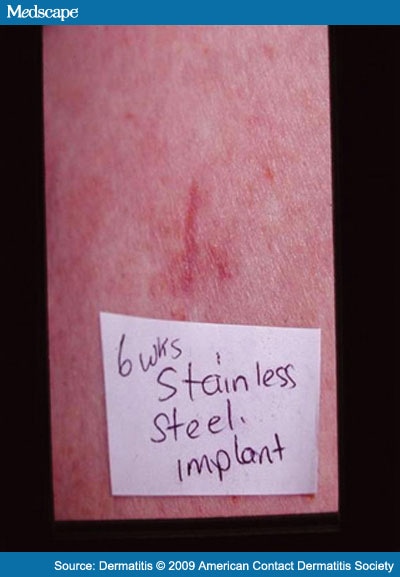 An Interesting Case of Joint Prosthesis Allergy - Page 2