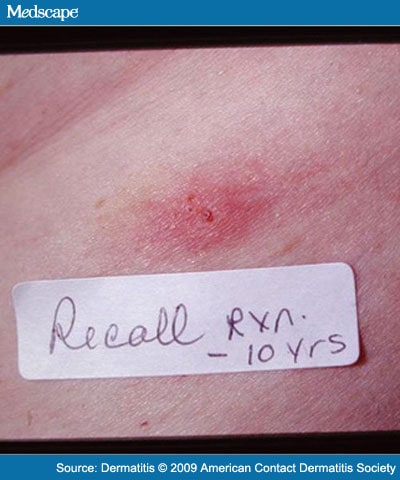 An Interesting Case of Joint Prosthesis Allergy - Page 2