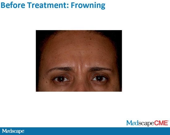 Periorbital Rejuvenation With AbobotulinumtoxinA in Skin of Color