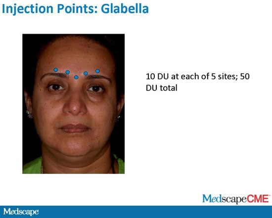 Periorbital Rejuvenation With AbobotulinumtoxinA in Skin of Color