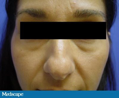 Improving the Shape of the Nose by Rhinoplasty