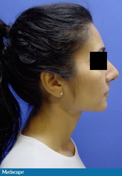 Improving the Shape of the Nose by Rhinoplasty