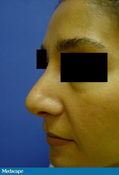 Improving the Shape of the Nose by Rhinoplasty