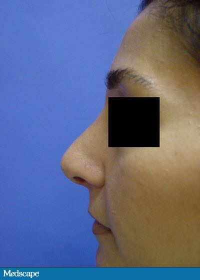 Improving the Shape of the Nose by Rhinoplasty