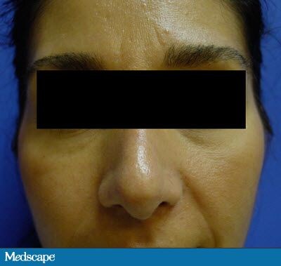 Improving the Shape of the Nose by Rhinoplasty