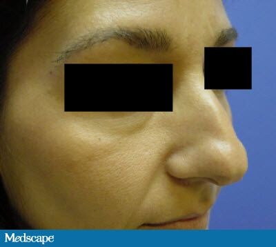 Improving the Shape of the Nose by Rhinoplasty
