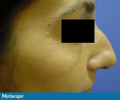 Improving the Shape of the Nose by Rhinoplasty
