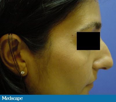 Improving the Shape of the Nose by Rhinoplasty