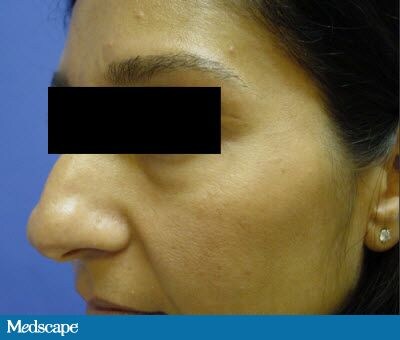 Improving the Shape of the Nose by Rhinoplasty