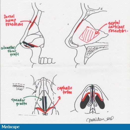 Improving the Shape of the Nose by Rhinoplasty