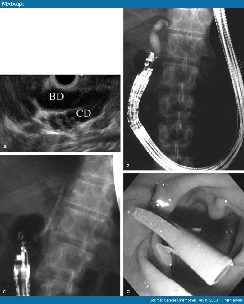 Interventional Endoscopic Ultrasonography - Page 4