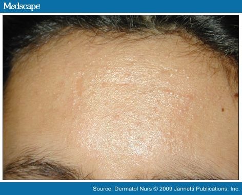 Acne Vulgaris: Review and Guidelines