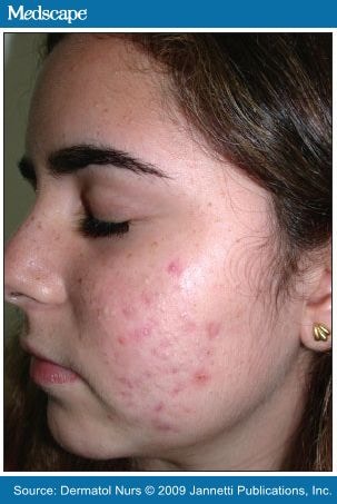 Acne Vulgaris: Review and Guidelines