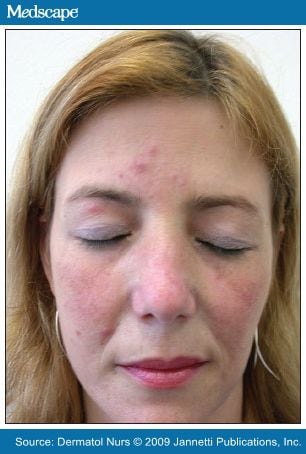 Acne Vulgaris: Review and Guidelines