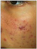 Acne Vulgaris: Review and Guidelines