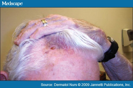 A Bruise-Like Patch to the Forehead and Scalp