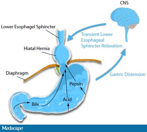 The Evolving Landscape in GERD: What Are the Issues/Unmet Needs and ...