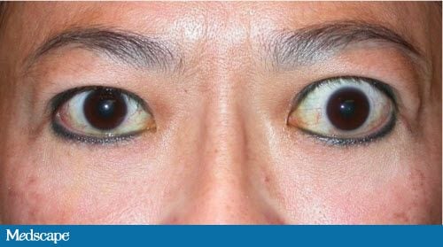 A 56-Year-Old Woman With a Progressively Bulging Eye