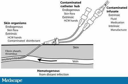 Catheter-Related Infections: Bundle Up for Prevention